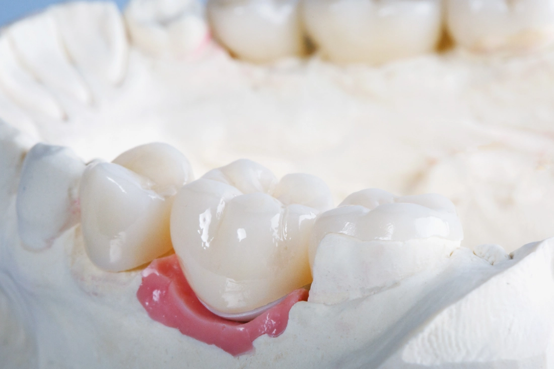 How Long Do Crowns Last? Lifespan, Application, & Care Tips
